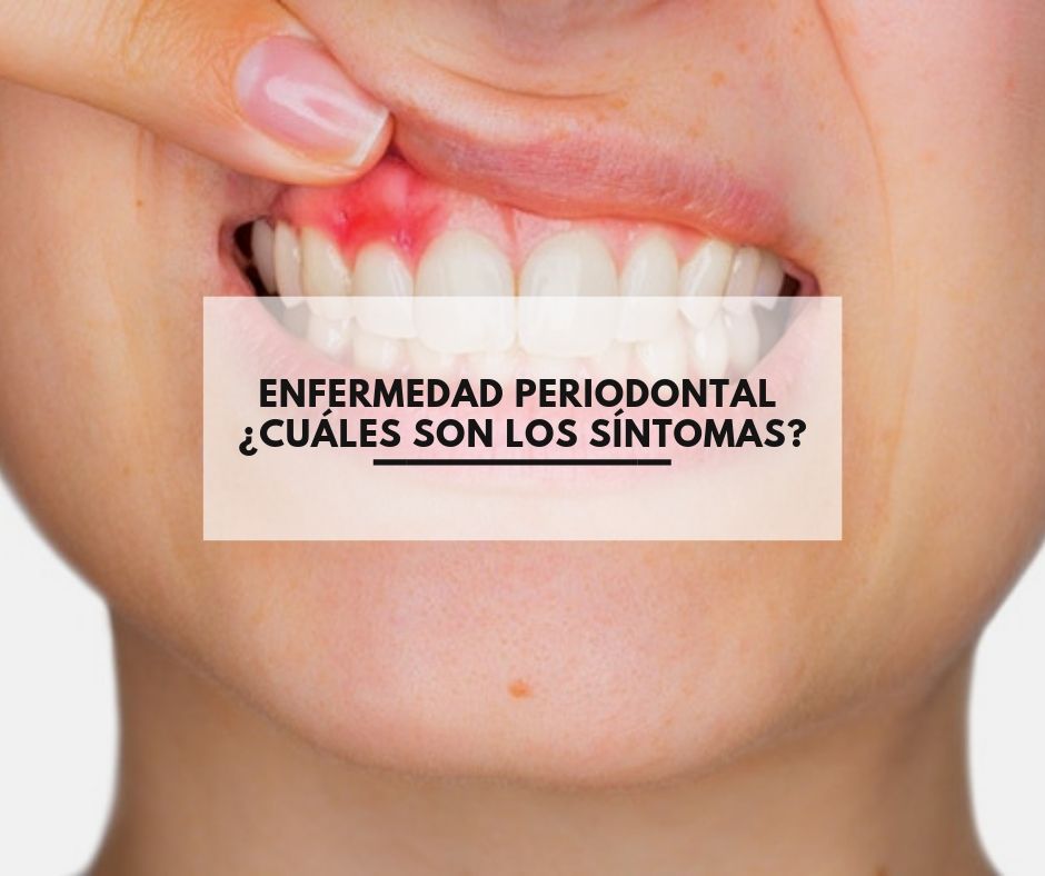 Enfermedad Periodontal ¿Cuáles son los síntomas